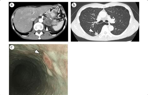 Ct And Upper Gastrointestinal Endoscopy Findings At Presentation