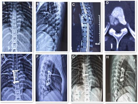 Fifty Six Year Old Man With Short Segment Thoracic Vertebra Download Scientific Diagram