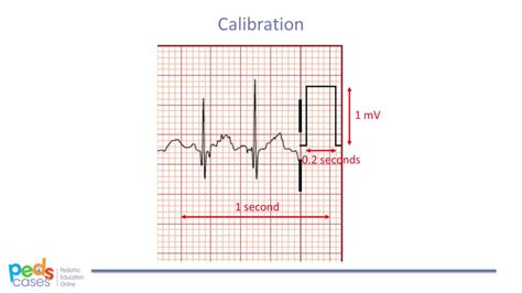 Approach To Pediatric Ecgs Part 12 Youtube