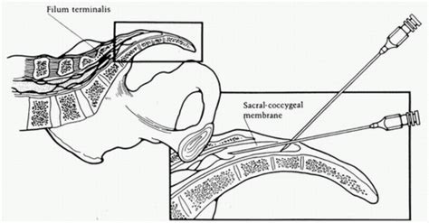 Spinal Epidural And Caudal Anesthesia Anesthesia Key