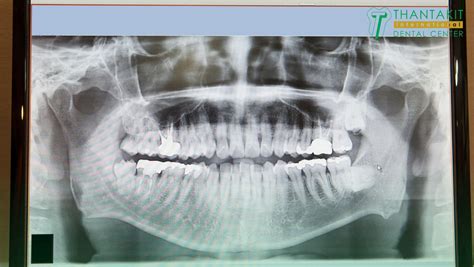 Understanding Impacted Teeth What Are Wisdom Teeth