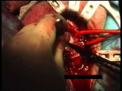 Urethroplasty Using Buccal Mucosa Video MEDtube Net