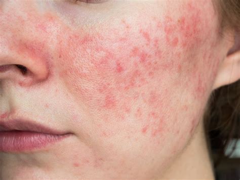 What Are Demodex Mites Facty Health