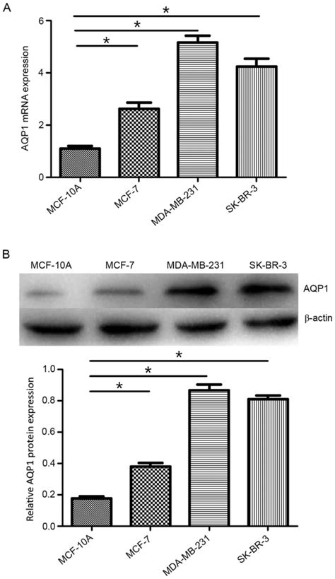 Aquaporin 1 Knockdown Inhibits Triplenegative Breast Cancer Cell