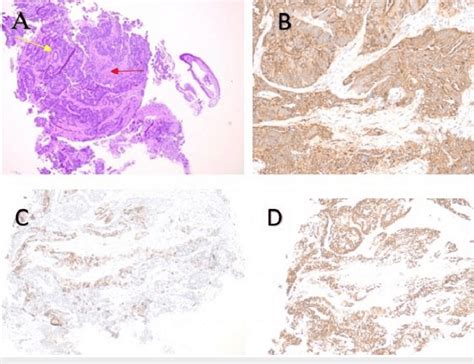 Histopathology From Tissue Sample Obtained At The Time Of Ptc The