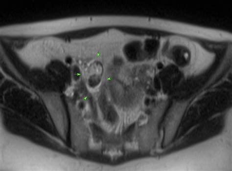 Heterotopic Pregnancy Following Spontaneous Conception A Rare