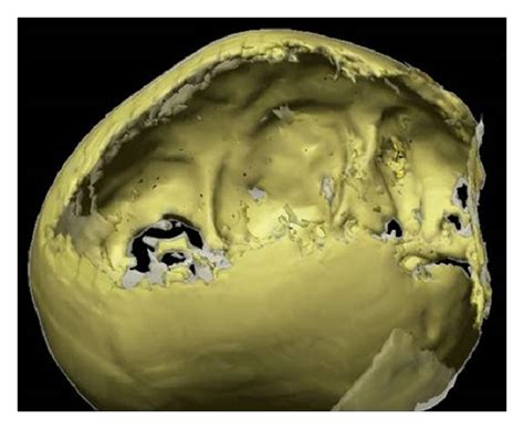 Three Dimensional Reconstructions With Brainlab A Right Lateral