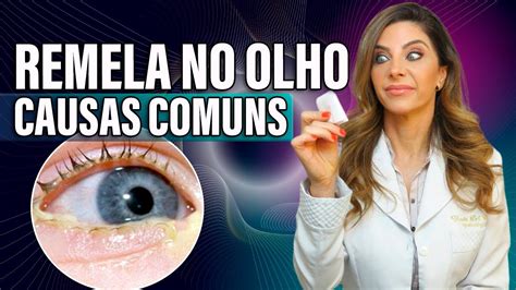 Remela No Olho Causas Comuns YouTube