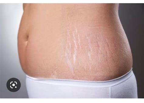 Stretch Marks Causes Risk Factors And Prevention Home Of Ghana News