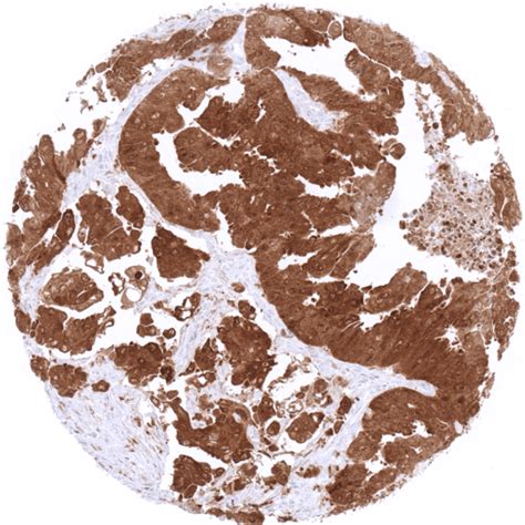 Cancer Tissue Gallery P16 Ms Validated Antibodies