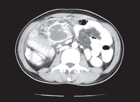Ct Scan Of Abdomen Showing Hypodense Lesion In The Mesentry With Thick
