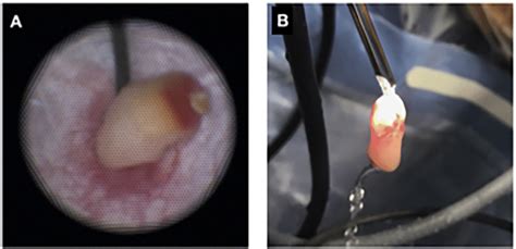 Urethral Polyp