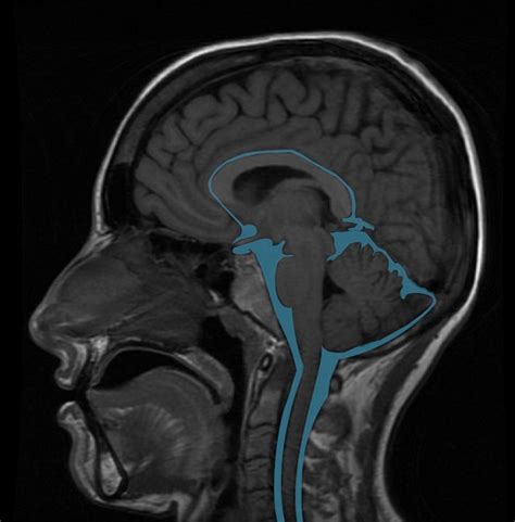 Subarachnoid Cisterns Stroke Manual