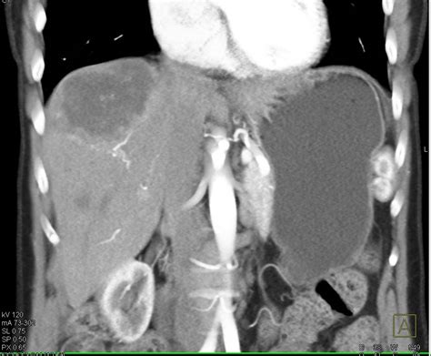 Necrotic Liver Metastases Due To Metastatic Gist Tumor Liver