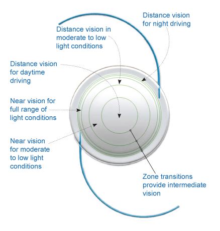 Intraocular Lens Options For Cataract Surgery