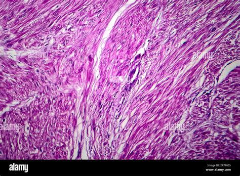 Uterine Fibroid Light Micrograph Lm Of A Section Through Tissue From