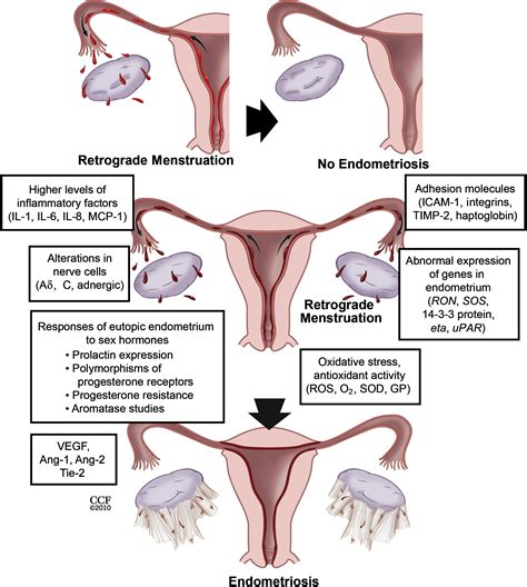 Role Of Eutopic Endometrium In Pelvic Endometriosis Journal Of