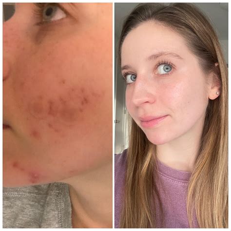 Tretinoin Before And After Acne
