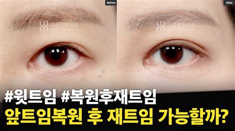 앞트임복원 후 재트임 가능할까 윗트임 복원후재트임 Youtube