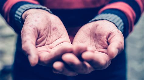 Viruela Del Mono Qué Es Causas Síntomas Y Tratamiento