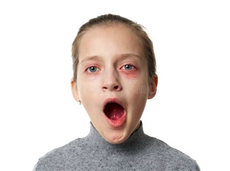 Réaction Allergique éruption Cutanée Portrait Proche De Vue Du Visage D une Jeune Fille