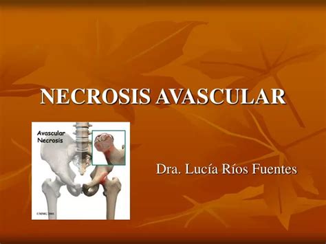 Ppt Necrosis Avascular Powerpoint Presentation Free Download Id