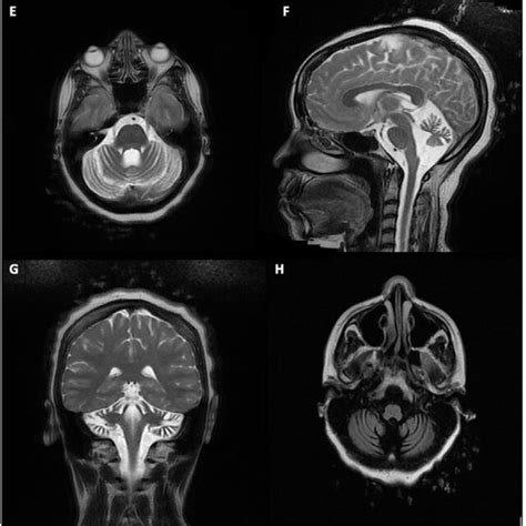 T2 Weighted A Axial T2 B Sagittal T2 C Coronal 2 D T2 Flair