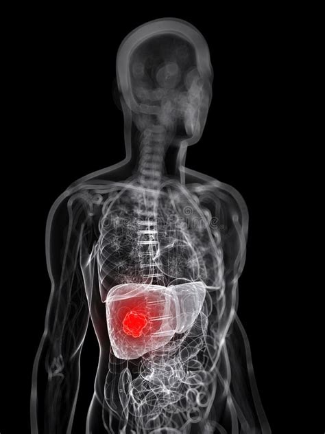 Liver Tumor Stock Illustration Illustration Of Graphic 23711056