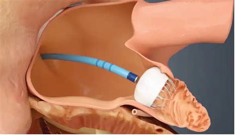 What Is Left Atrial Appendage Occlusion For Atrial Fibrillation Af
