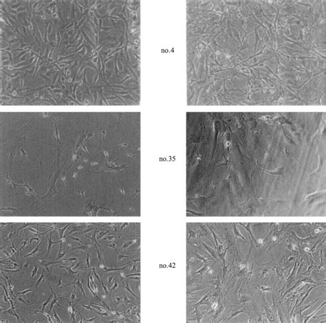 Morphological Analysis Of Primary Cultures Of The Meningiomas Nos 1 4