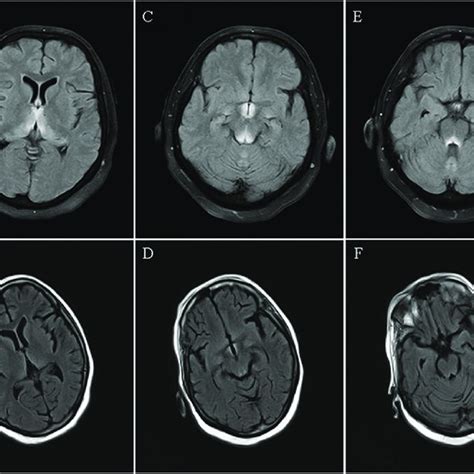 A High Signal Intensity In Flair Sequence In The Dorsomedial Thalami