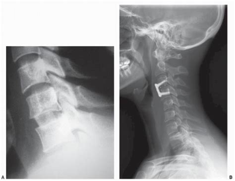 Spinal Instrumentation In Degenerative Disorders Of The Cervical Spine