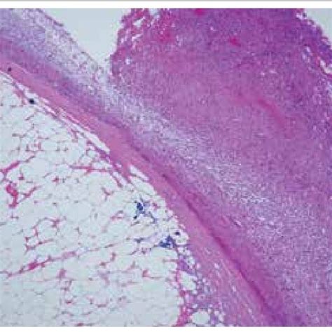 Histopathology Showing Fat Necrosis Fibrosis Old Blood And Chronic