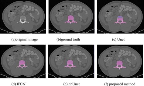 Horizontal Visualization Of Lumbar Vertebrae Segmentation Results Of