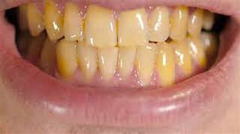 Yellow Tooth Problem Will Disappear Instantly With Mustard Oil Yellow Teeth ಈ ಹಳದಿ ವಸ್ತುವಿನಿಂದ