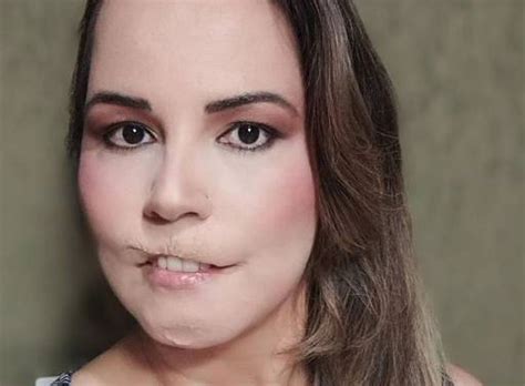 Mulher Perde O Lábio Superior Após Fazer Preenchimento Com Pmma