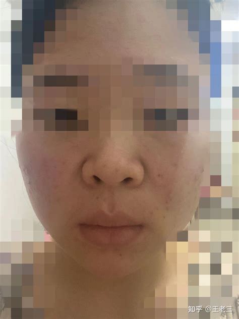 异维A酸软胶囊口服打卡 知乎