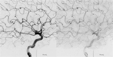 Anterior Choroidal Artery