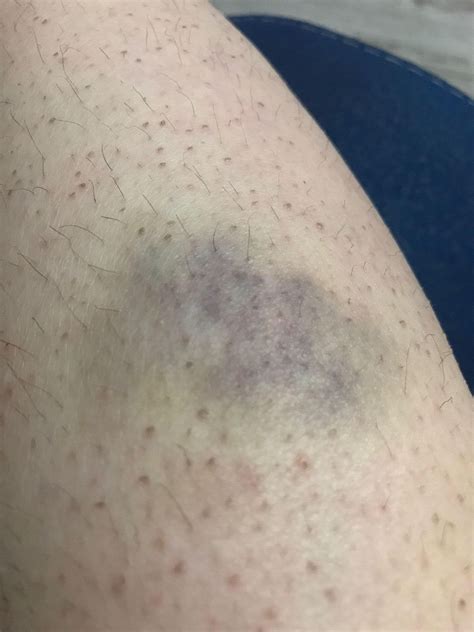 24f 110 Lbs 53 Weird Marks On Legs After Walking Raskdocs