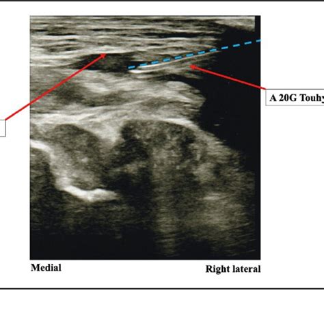Representative Ultrasound Image Of Right Fascia Iliaca Block The