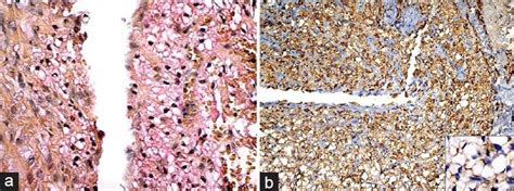 Sialomucin Content Is Demonstrated By Mucicarmine Staining A
