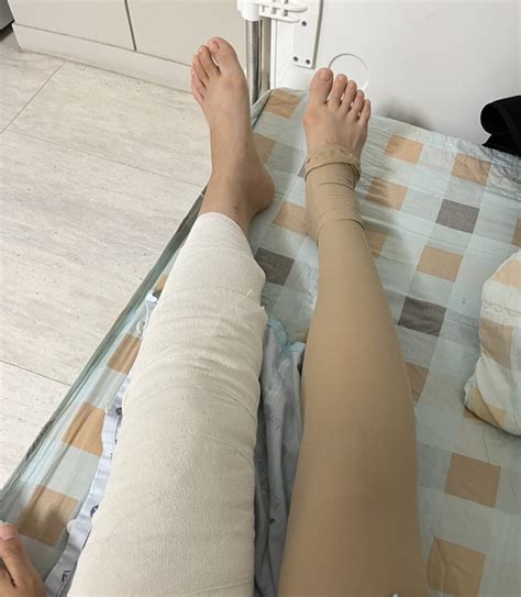 여자 전방 십자인대파열 후기 완전파열 수술 일반인o 운동선수축구 X 네이버 블로그