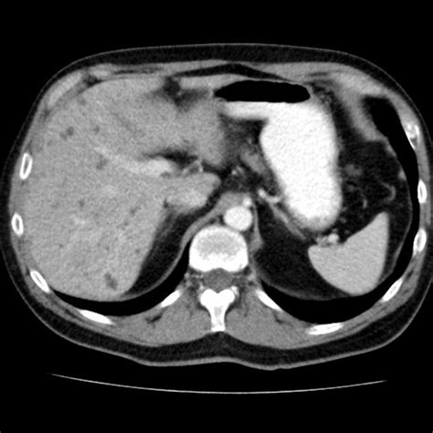 47 Best Images About Hepatobiliary On Pinterest Type 1 Gallstone And The Portal