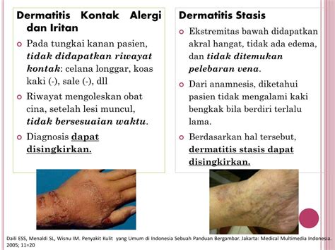 Ppt Presentasi Kasus Dermatitis Numularis Powerpoint Presentation