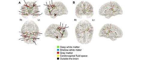 The Locations Of Depth Electrode Contacts A Depth Electrodes Placed