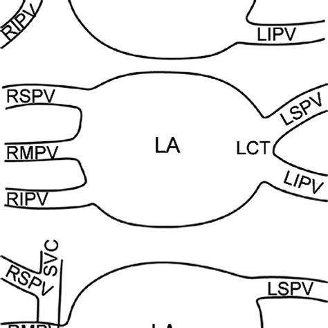 Diagrams Show Pulmonary Venous Drainage Patterns In Patients With Four