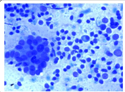 Cells Gave The Smear A Lymph Node Appearance Referred To As Lymph
