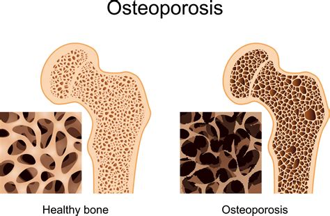 What Causes Osteoporosis Medguidance