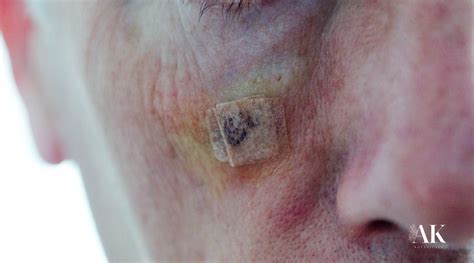 Actinic Keratosis Vs Seborrheic Keratosis Understanding The Differen
