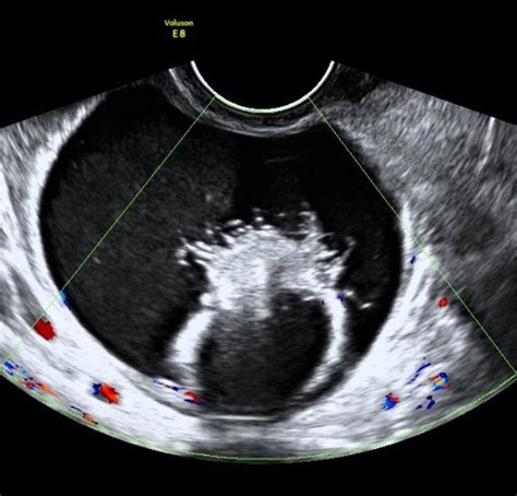 Mature Cystic Ovarian Teratoma Radiology Reference Article